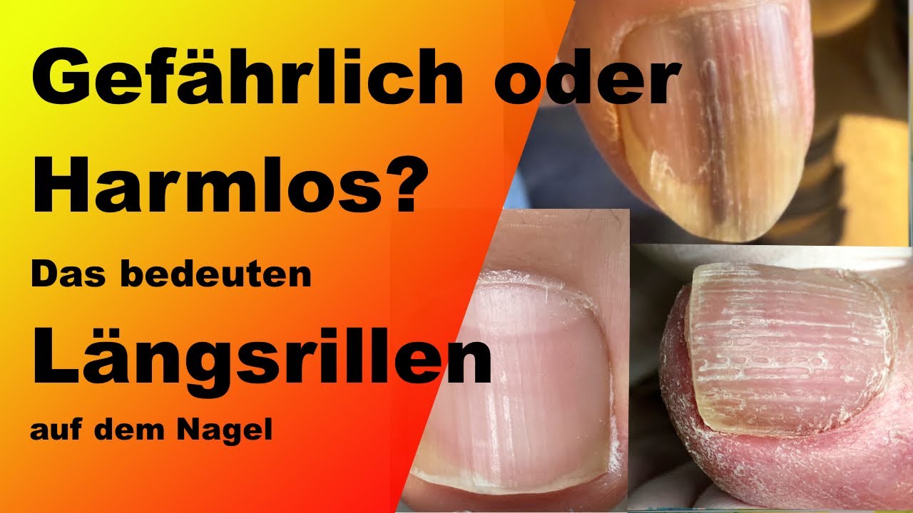 Gefährlich oder harmlos? Das bedeuten Längsrillen auf deinen Nägeln ...