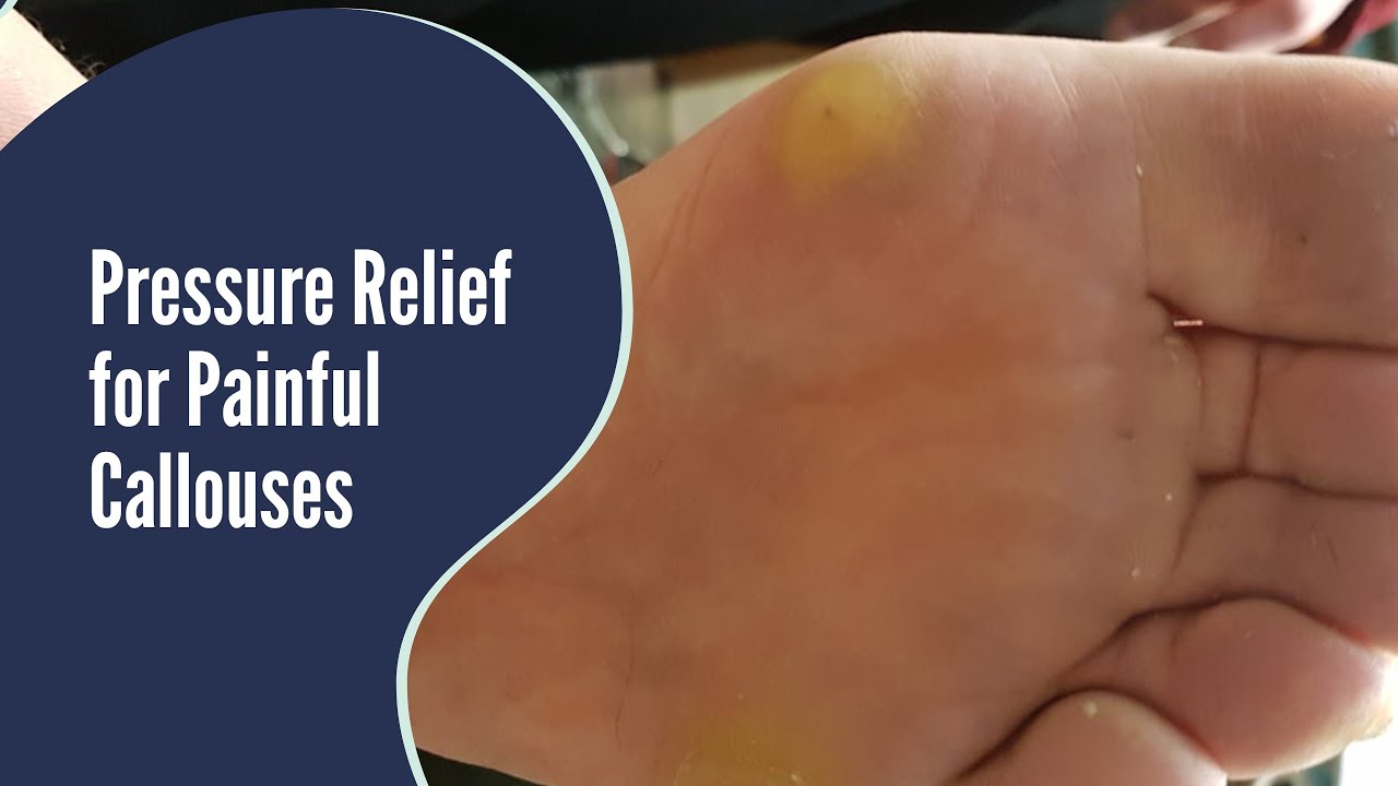 PAINFUL CALLUS PRESSURE RELIEF - YouTube