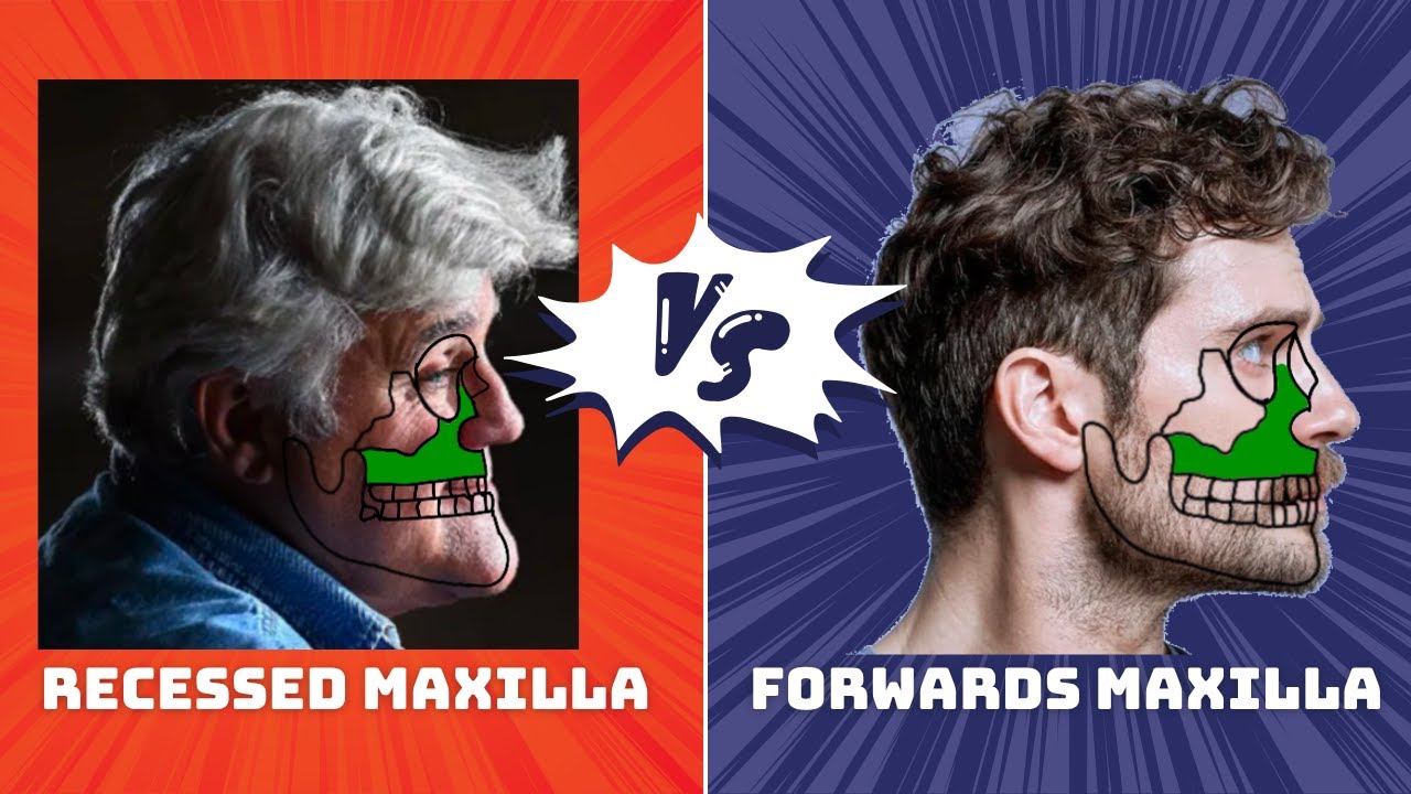 Recessed Maxilla Vs. Forwards Maxilla - YouTube