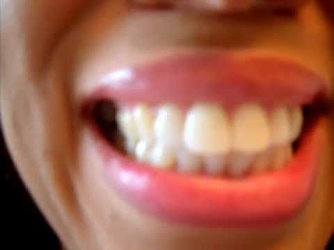 Snap It /Snap on Smile Review - YouTube