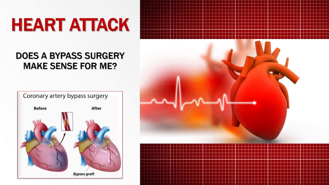 HEART ATTACK - DOES A BYPASS SURGERY MAKE SENSE FOR ME? - YouTube