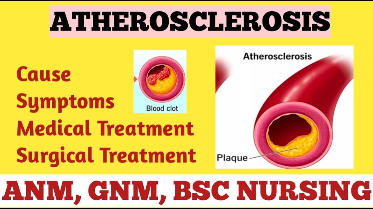 Atherosclerosis | Plaque formation | Cholesterol - HDL, LDL | Surgical Treatment | by Priyanka ...