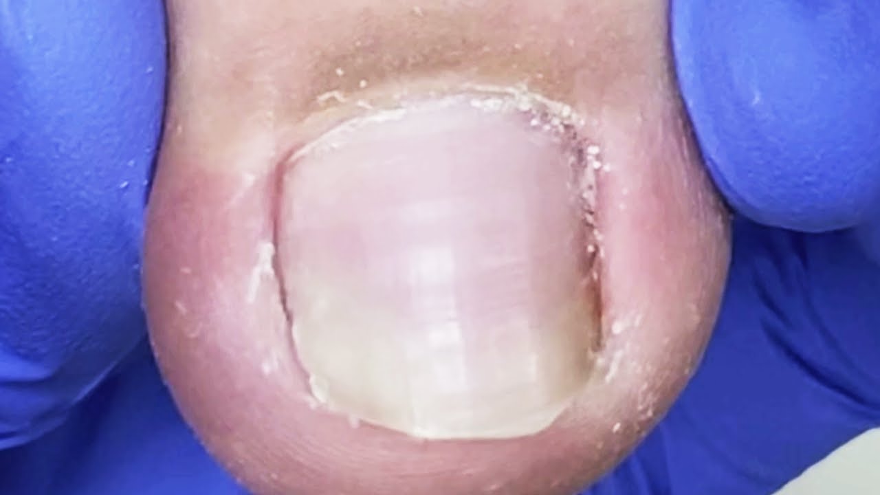 If you don't cut your nails for a long time, it will cause paronychia ...