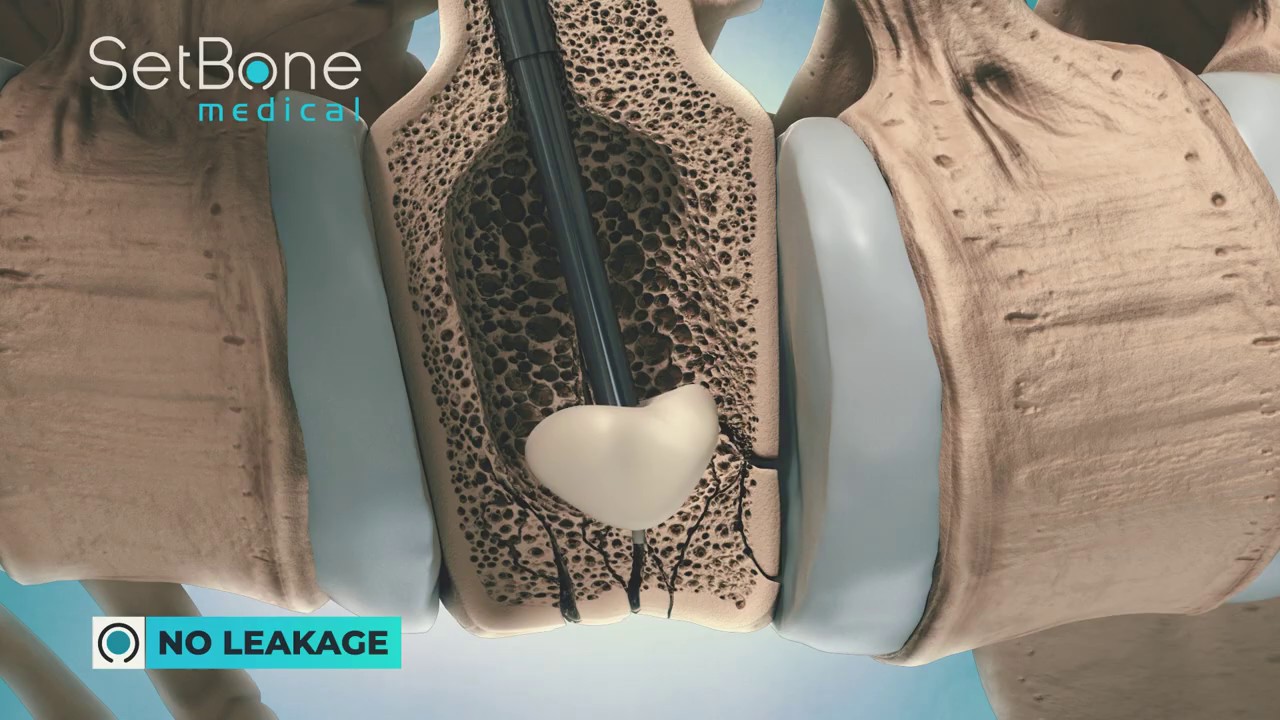 SetBone Medical s Novel Bone Cement YouTube