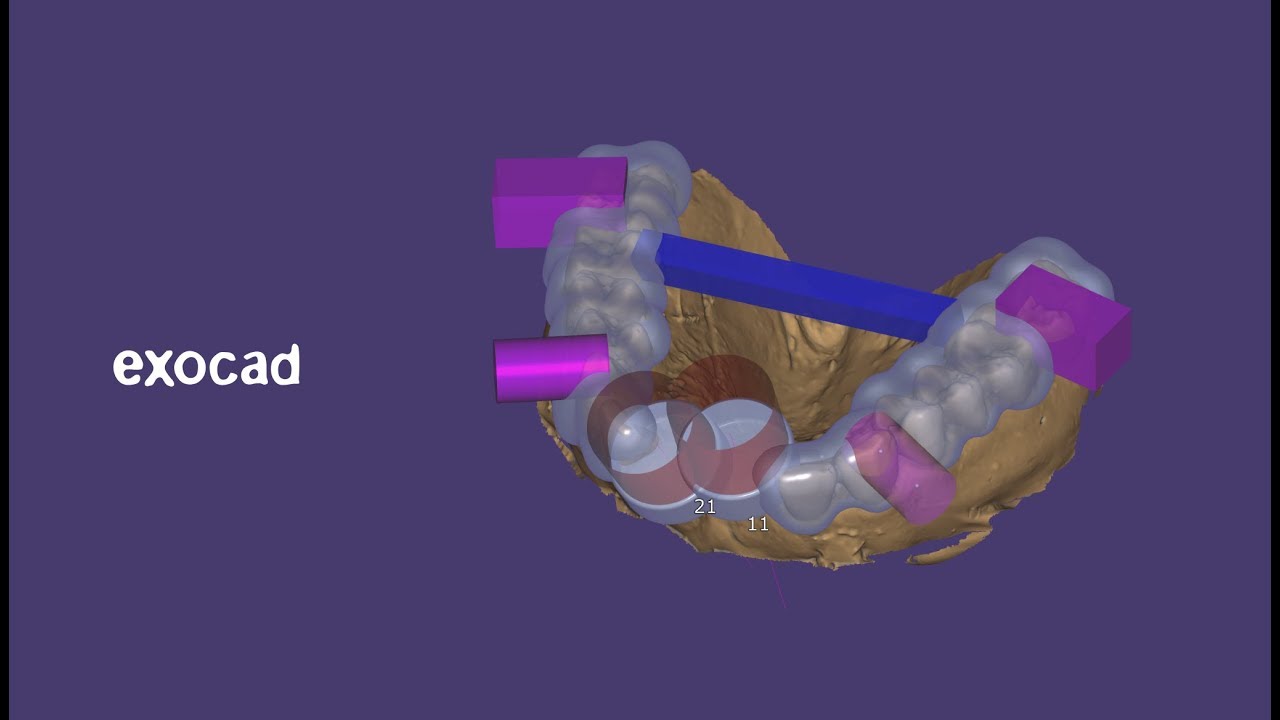 All on 4 implant planning in TWO minutes(!!!) EXOCAD (Exoplan mastera ...
