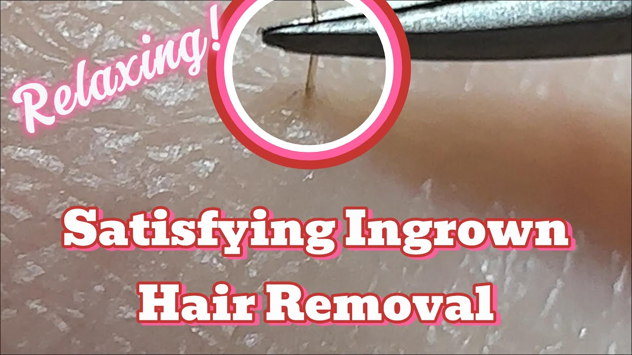 Satisfying plucking and ingrown hair removal - YouTube