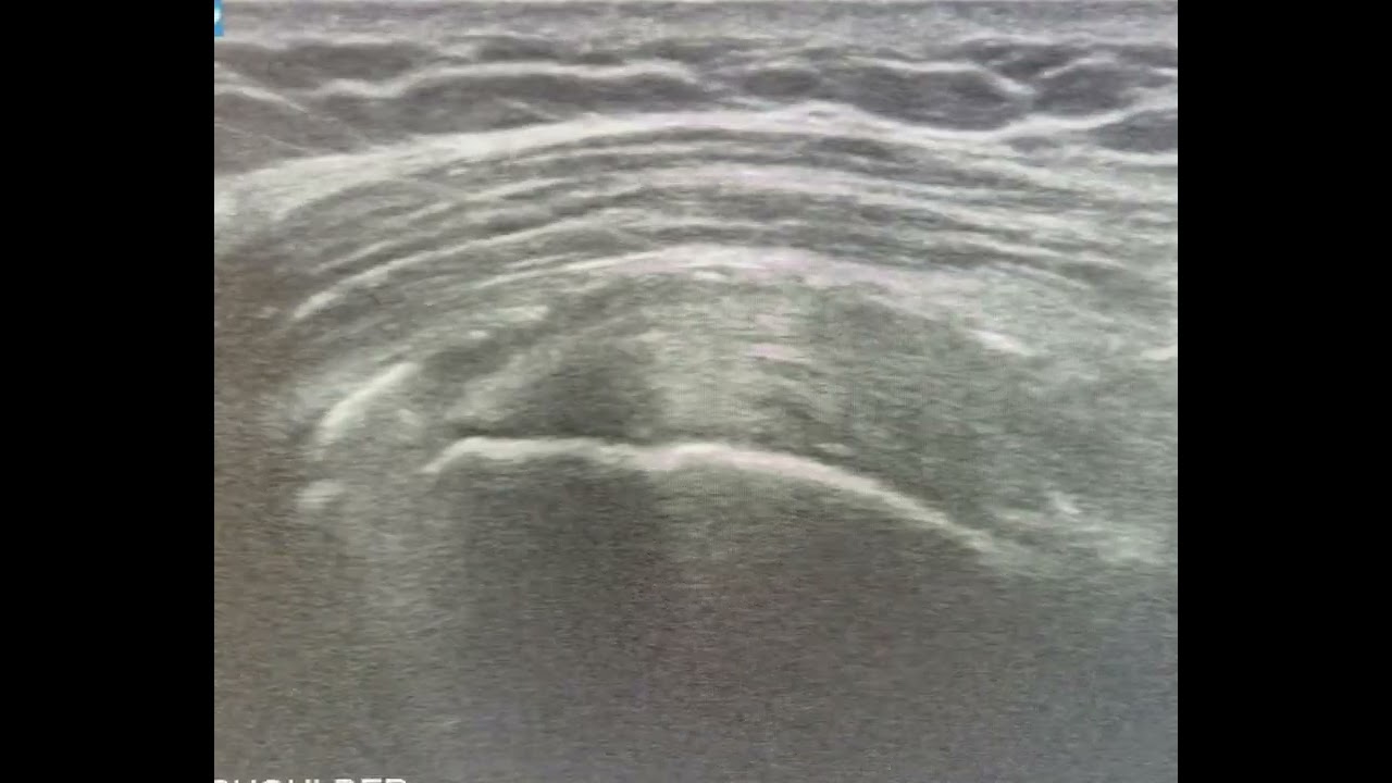 Ultrasound guided subdeltoid bursa injection with PRP demonstrating ...