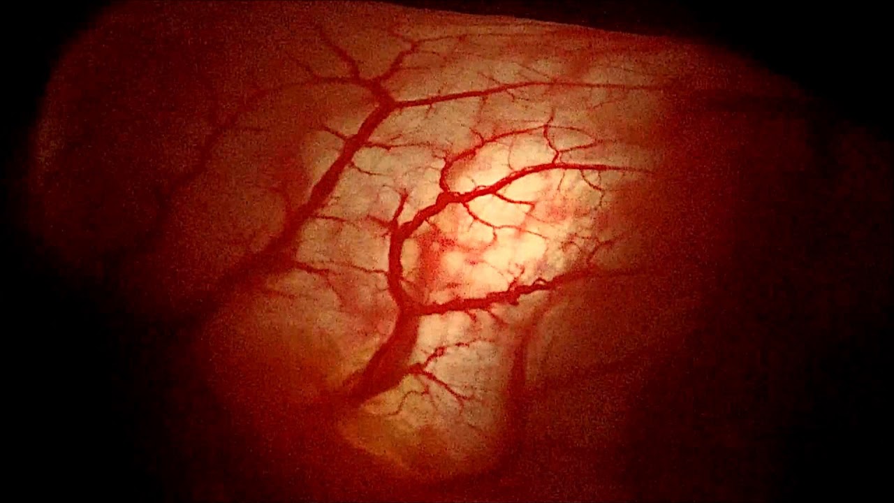 HYBRID SURGERY - Laparoscopic Endoscopic Cooperative Surgery - YouTube