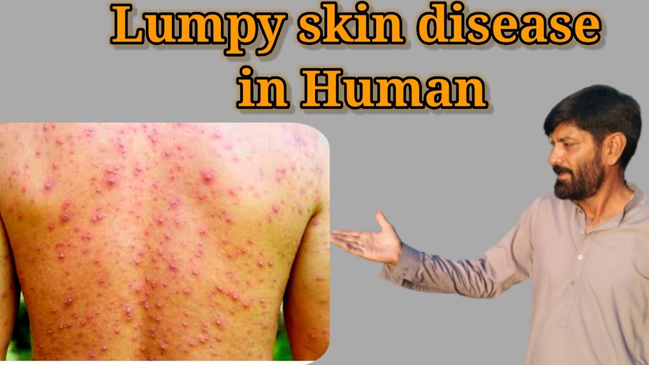 Lumpy skin disease in Human || Mulakh apna - YouTube