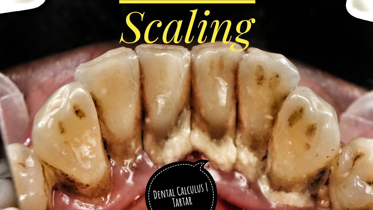 Scaling Dental Calculus Tartar - YouTube