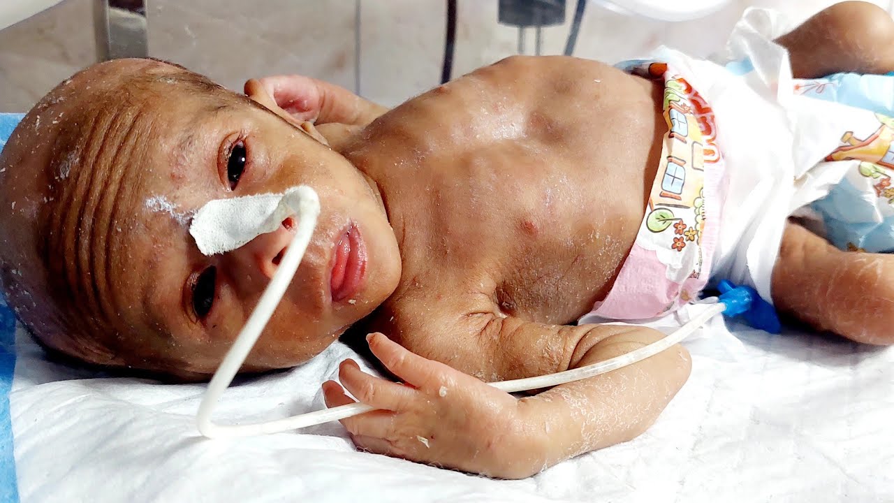 First feed to preterm/precious baby after recovery#nars #hospital ...