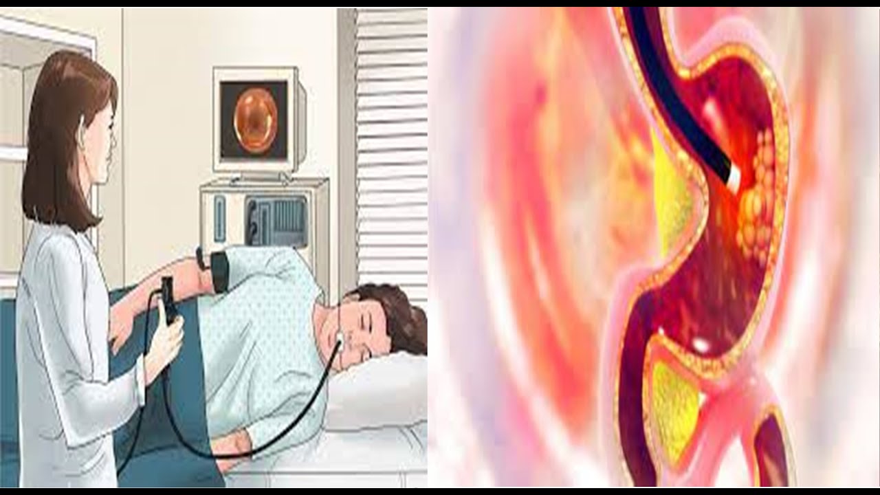 Vai fazer Endoscopia? Como se preparar e como é feito? - YouTube