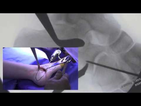 Modified Evans Procedure | Dr. David Feldman - YouTube