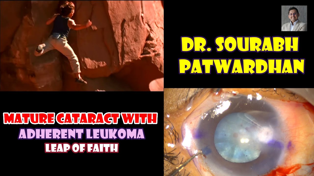 commented 47 Adherent Leukoma with intumescent cataract- Leap of faith ...