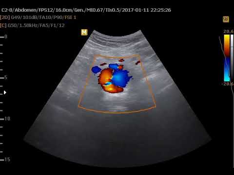 Case 62 : Abdominal aortic aneurysm: yin-yang sign - YouTube