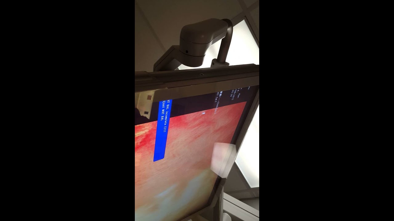 Cancer scope in the bladder - YouTube