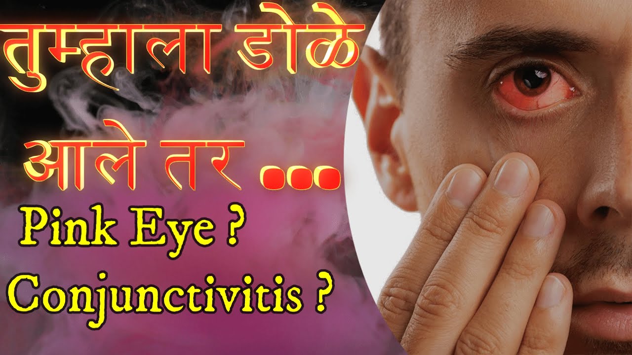 How to tackle 'Eye Flu' (dole yene)? डोळे येणे या साथीच्या रोगावर सर्व ...