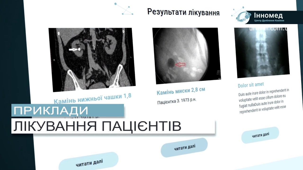 urovin.com.ua - сайті про сечокам‘яну хворобу - YouTube