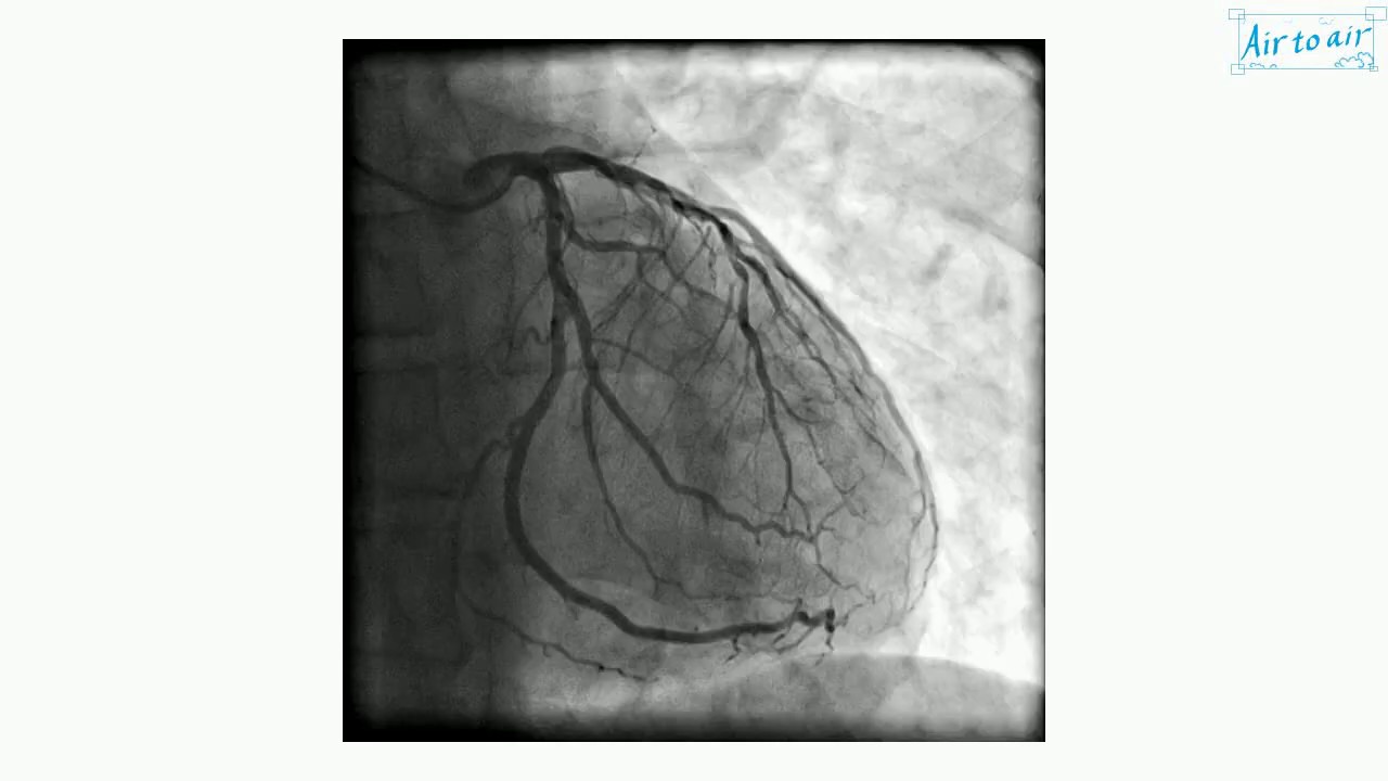 coronary angiography (English) - Medical terminology for medical ...