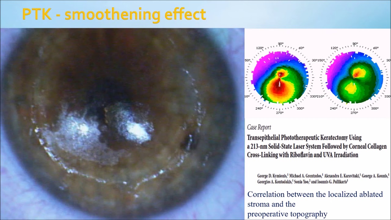 Keratoconus Advanced Laser Treatment | Asian Eye Hospital | Dr ...