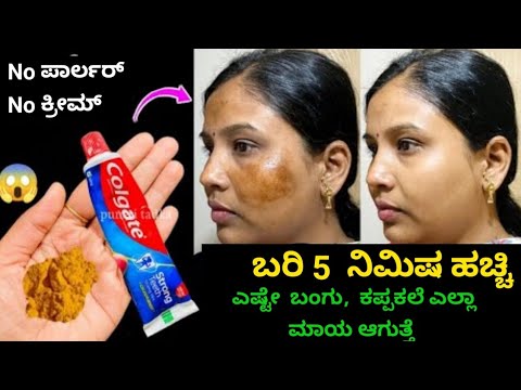 ಬಂಗಿಗೆ Noಕ್ರೀಮ್ No ಪಾರ್ಲರ್ ಮನೆಮದ್ದುಮಾಡಿ ವರುಷಳಿಂದ ಇರುವ ಬಂಗು ಕಪ್ಪುಕಲೆ ಮಾಯಆಗುತ್ತೆ /Pigmentation kannada