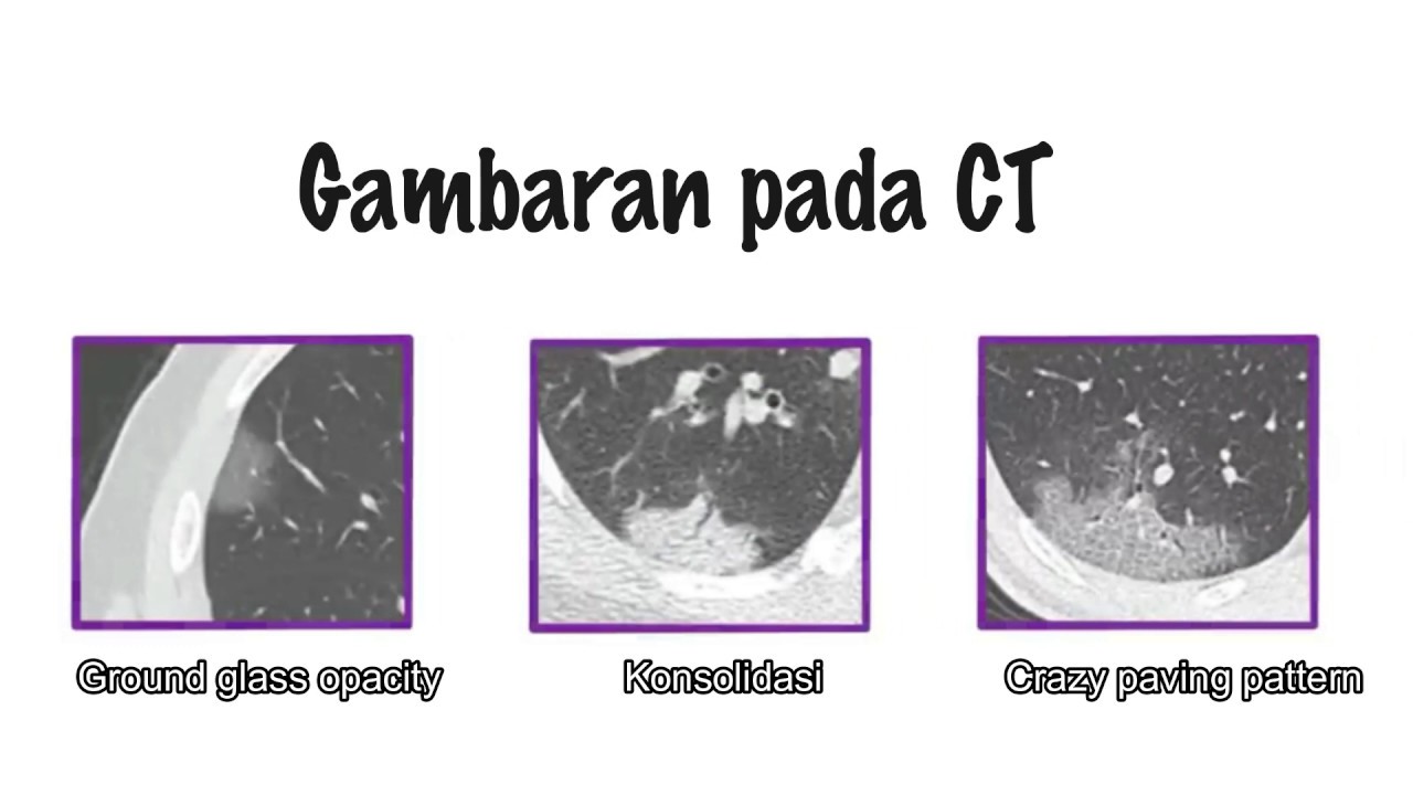Gambaran Radiologi Covid19 pada Rontgen Toraks dan CT scan Toraks part ...