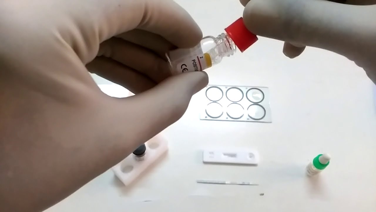 VDRL Test In Hindi RPR Test For Syphilis VDRL Test Procedure YouTube vdrl-test-in-hindi-rpr-test-for-syphilis-vdrl-test-procedure-youtube