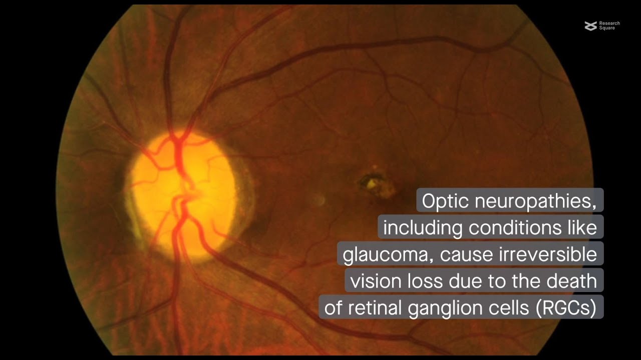 Understanding optic neuropathies: A new protocol for generating retinal ...