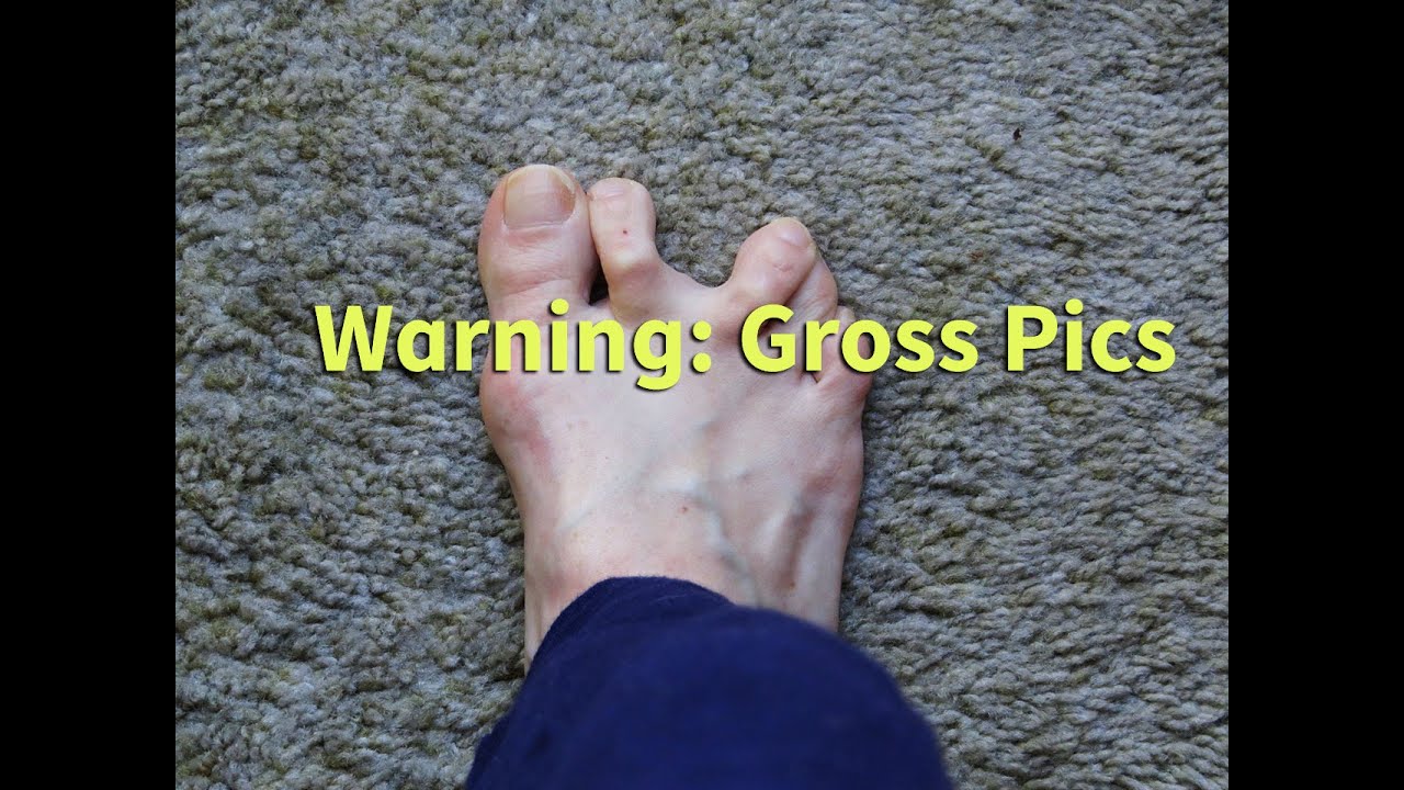 V-Shaped Toes and My Remedies - YouTube