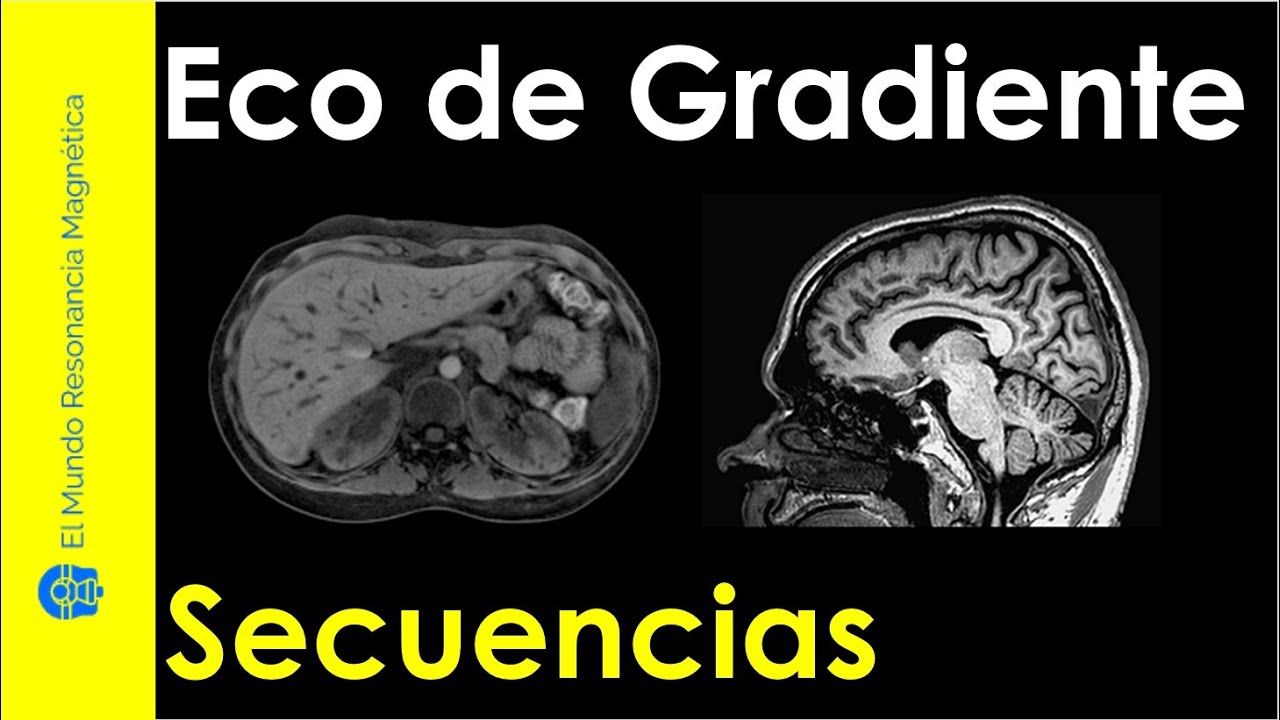 Vídeo 23 👌 Secuencias Eco de Gradiente Resonancia Magnética y su ...