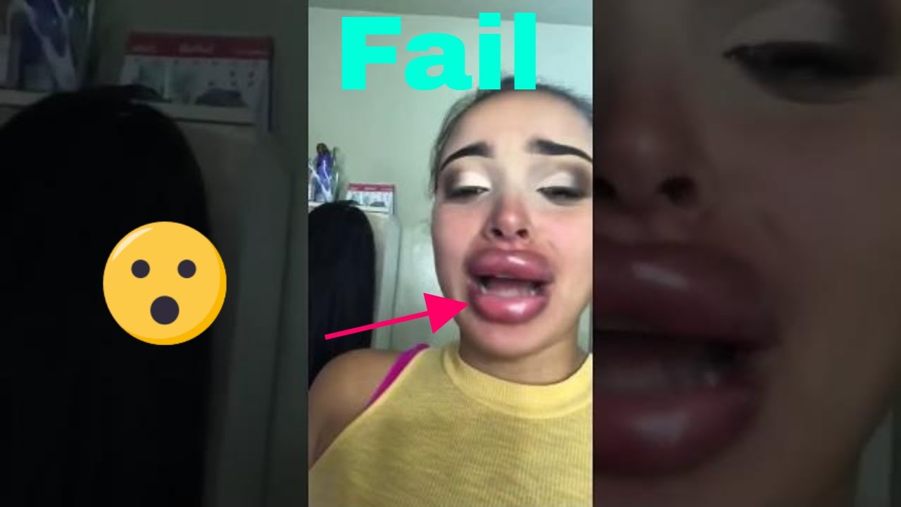 Lip Injections gone wrong.....PLASTIC surgery failed - YouTube