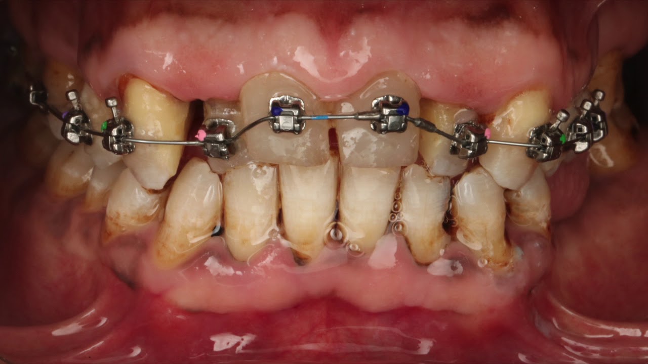 Pre-prosthetic orthodontic treatment (full mouth Rehabilitation) - YouTube