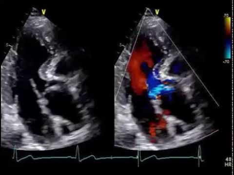 Unicuspid aortic valve - YouTube