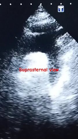 The Suprasternal Notch View #echocardiography#echocardiographicviews ...