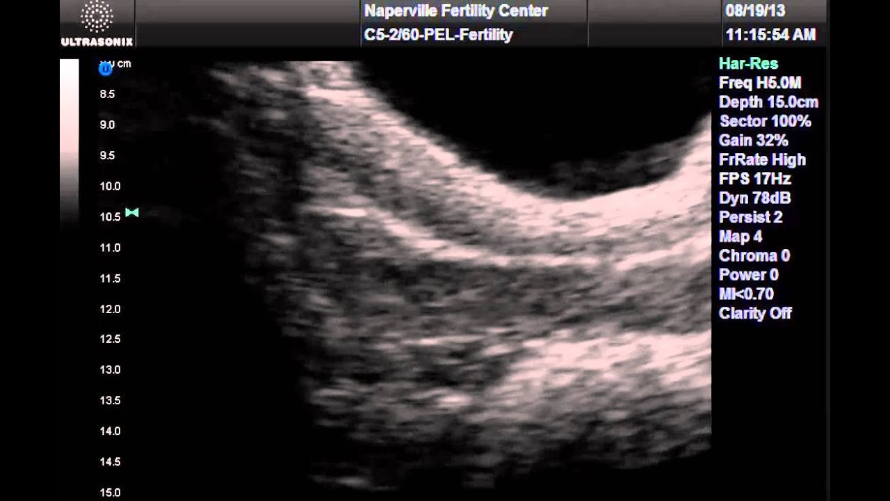 IVF Embryo transfer - YouTube