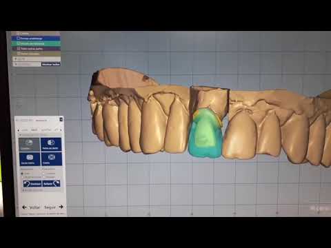 Exocad Redução coping - parte 1 - YouTube