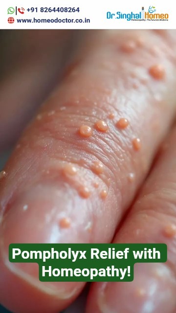 Pompholyx (Dyshidrotic Eczema) Homeopathy Treatment | Dr. Vikas Singhal ...