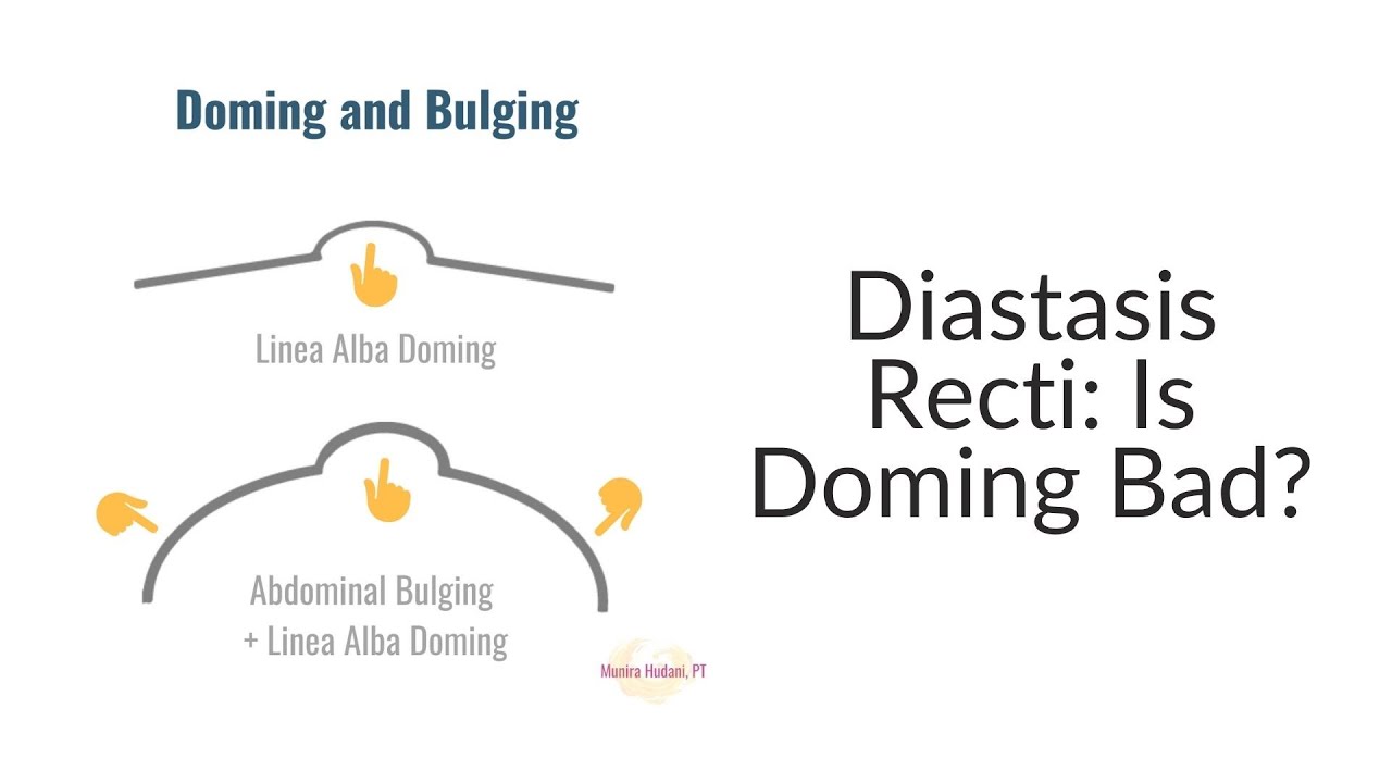 Diastasis Recti: Is doming bad? - YouTube