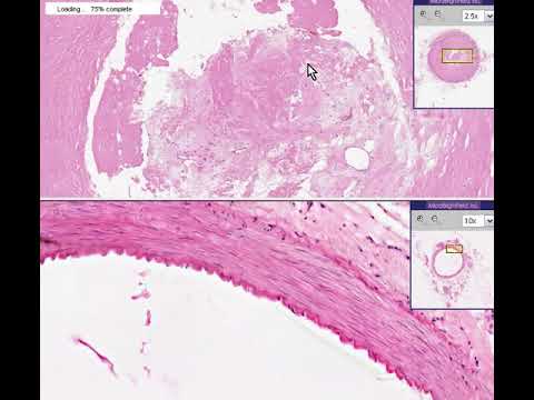 Coronary artery Atherosclerosis recanalization - YouTube