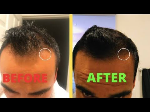 UPDATE! Perkembangan Menumbuhkan Rambut 3 Bulan Confident (bukan ...