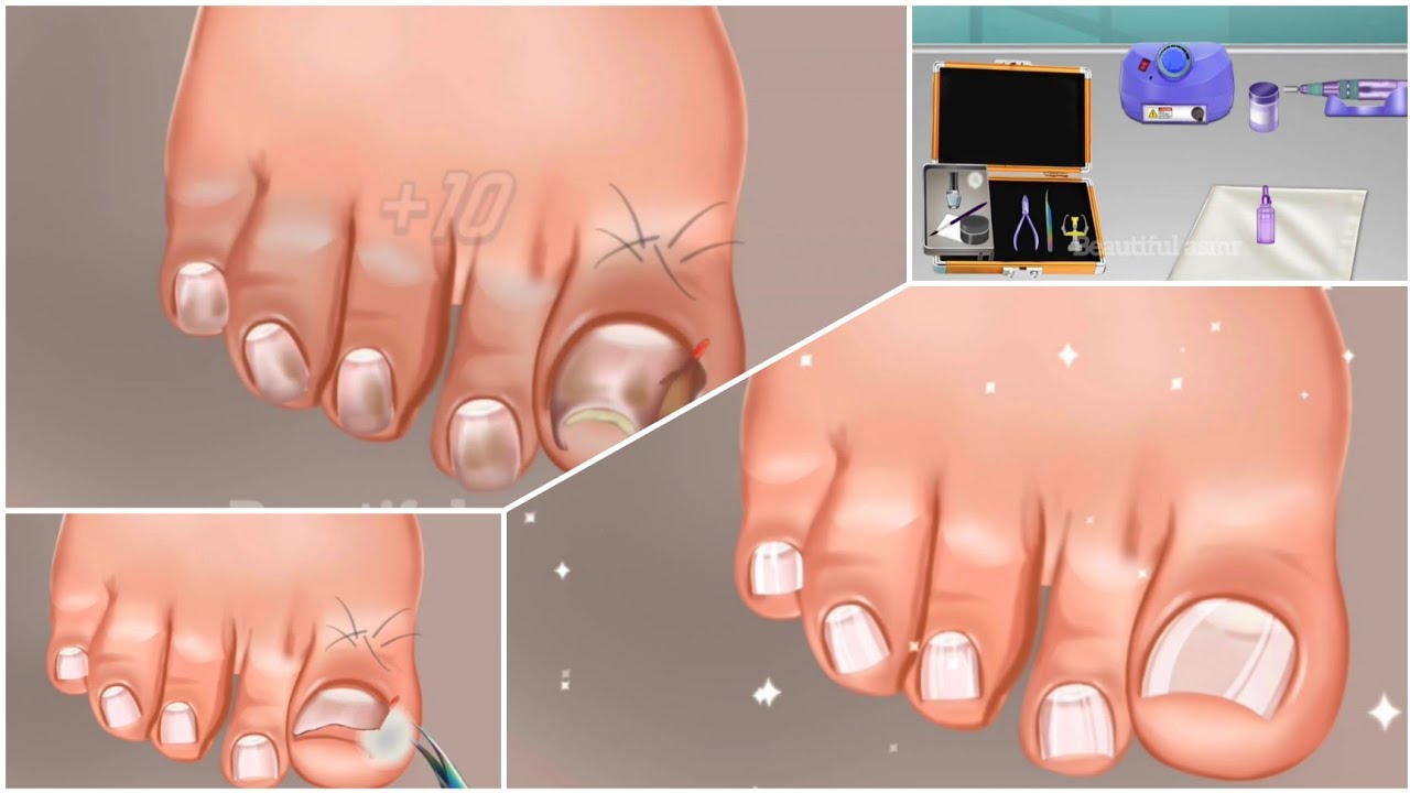 ASMR Animation Tutorial How To Remove Cut The Nails Of The Feet YouTube asmr-animation-tutorial-how-to-remove-cut-the-nails-of-the-feet-youtube