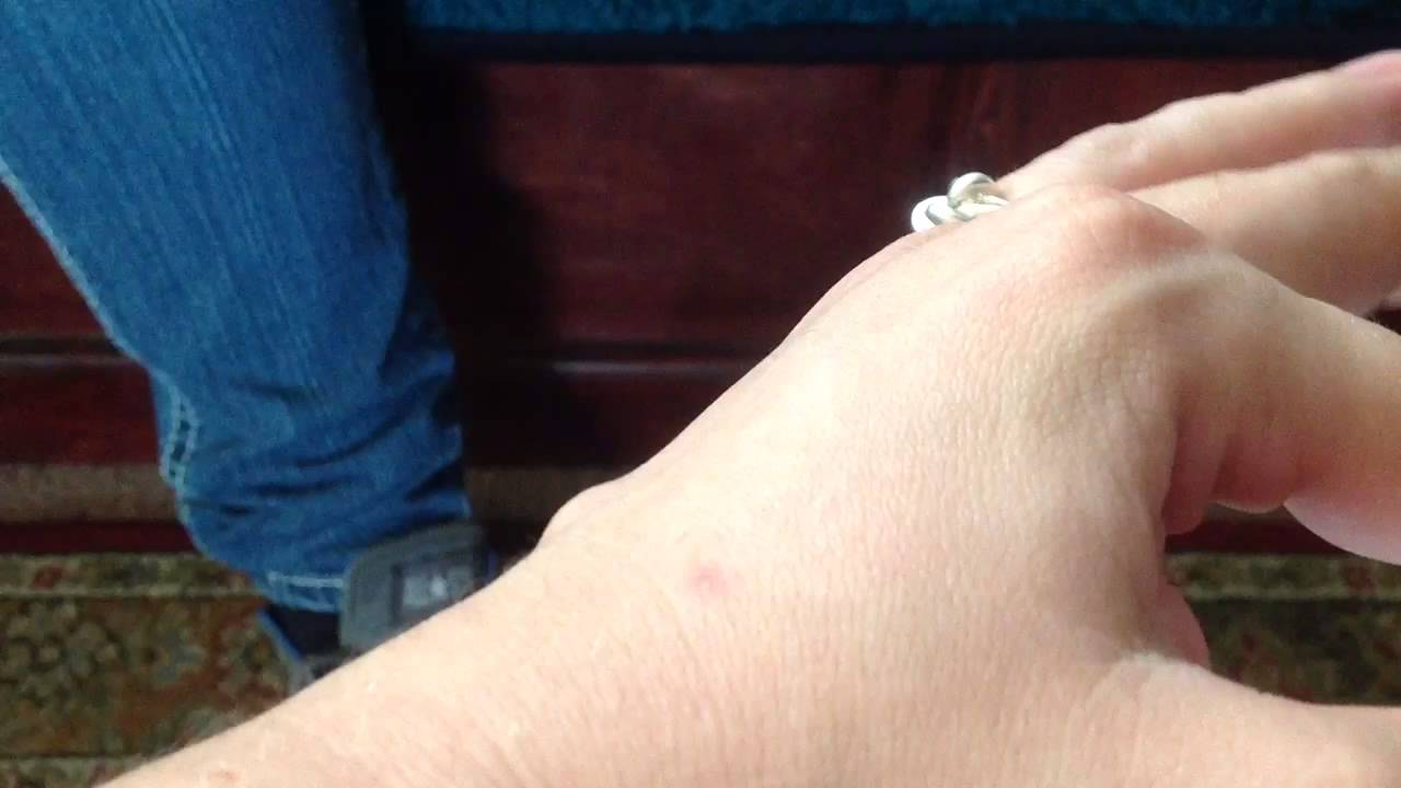 What is this Hard Lump on my hand? Ganglion Cyst #1 - YouTube