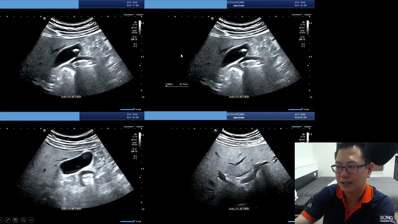 US reading : Gallbladder - YouTube