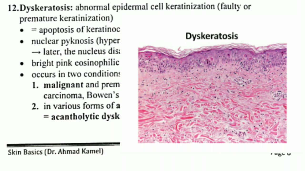 Dyskeratosis Congenita Histology