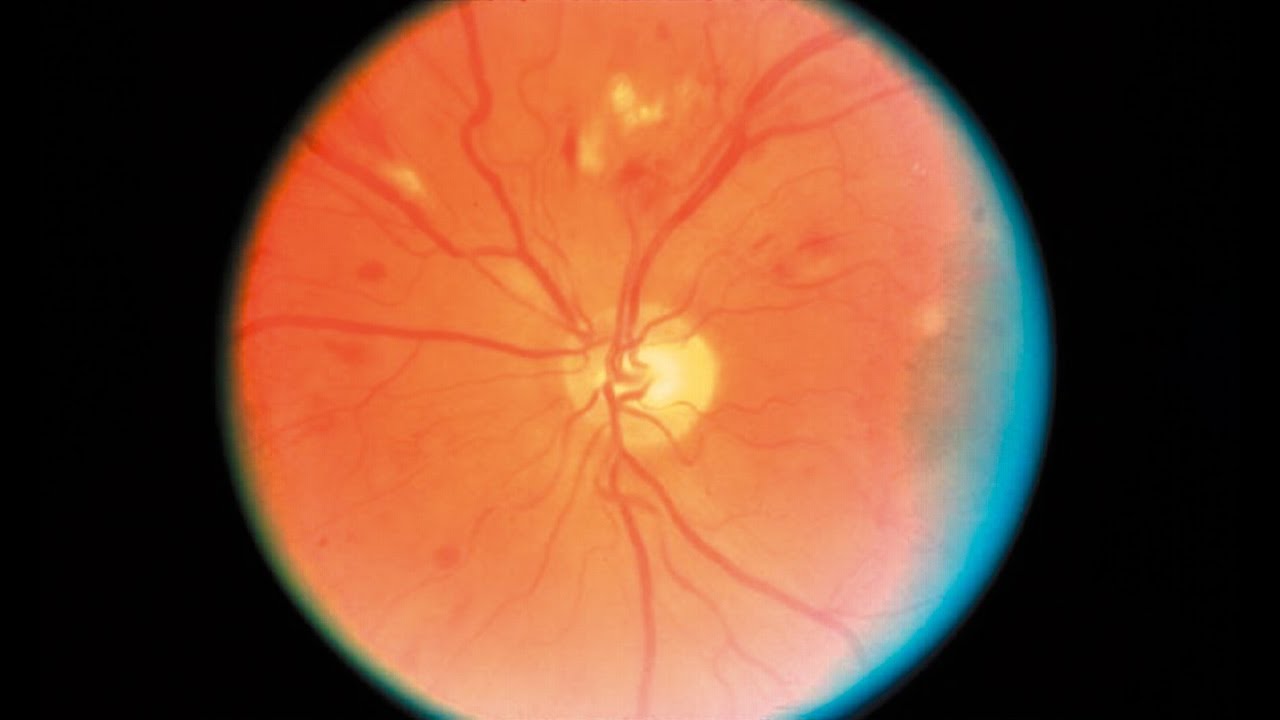 La retinopatía hipertensiva se asocia con un mayor riesgo de enfermedad ...