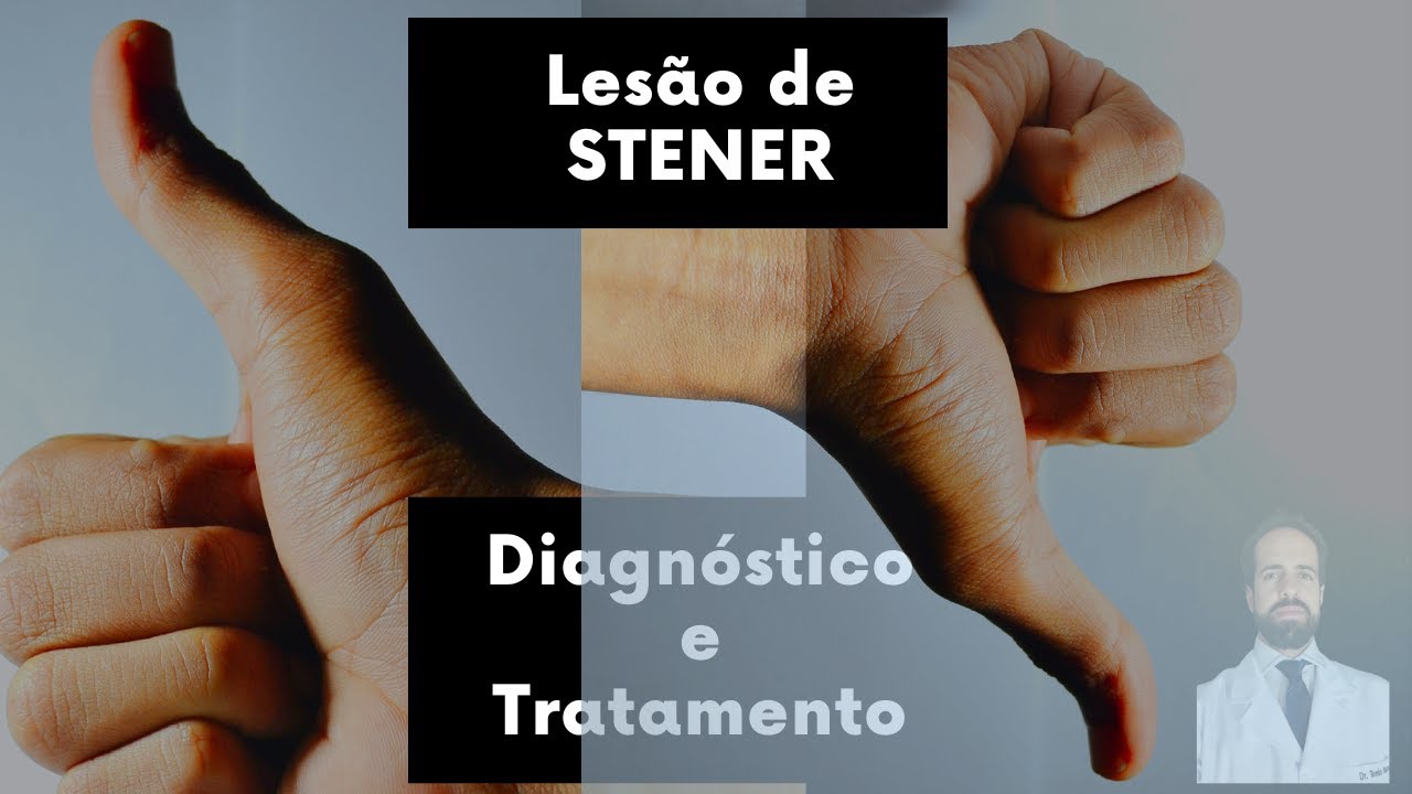 Lesão de Stener - Diagnóstico e Tratamento - YouTube