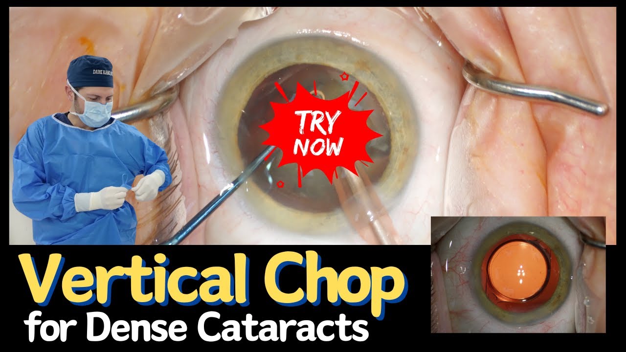 Vertical Chop | A Technique for Dense Cataracts - YouTube