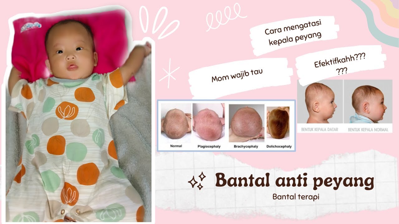 TIPS MENGATASI KEPALA BAYI PEYANG | TERAPI KEPALA BAYI | BANTAL PEYANG ...