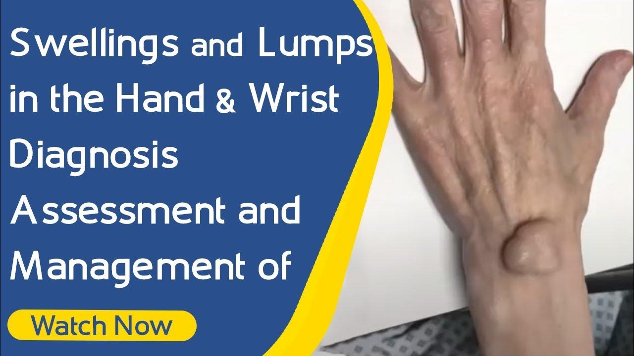 Swellings And Lumps In The Hand Wrist Diagnosis Assessment And swellings-and-lumps-in-the-hand-wrist-diagnosis-assessment-and