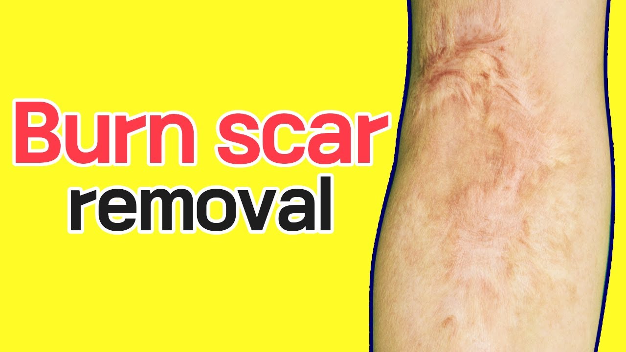 In the spring, I treated a 29-year-old burn scar. - YouTube